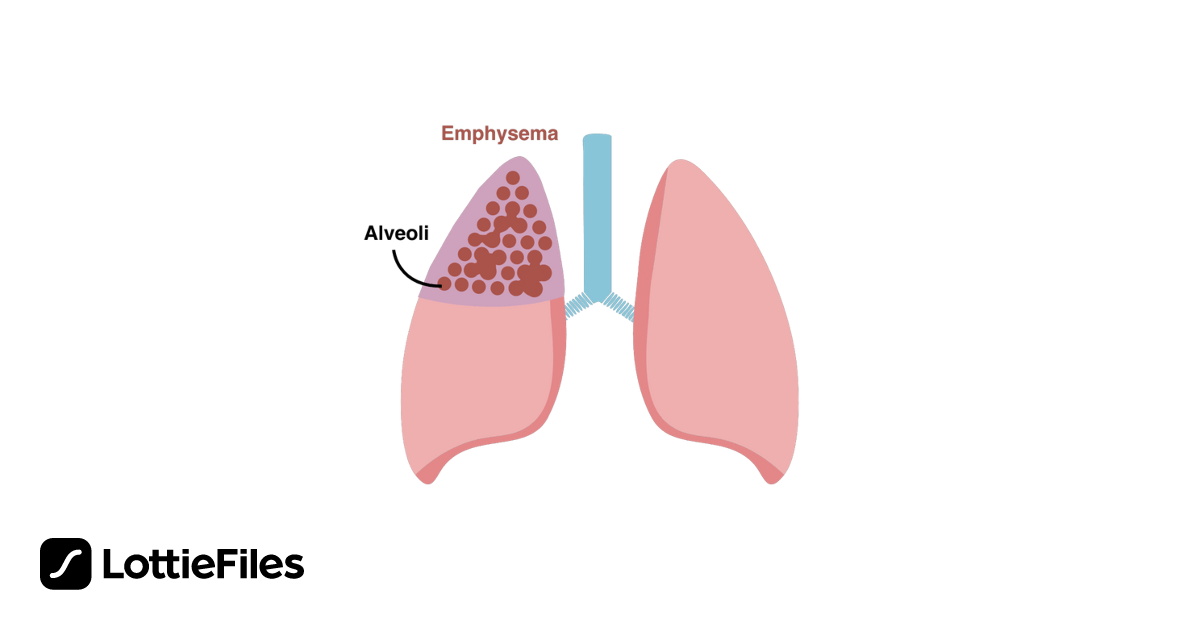 Free Emphysema lungs Animation by Joana Barreira | LottieFiles
