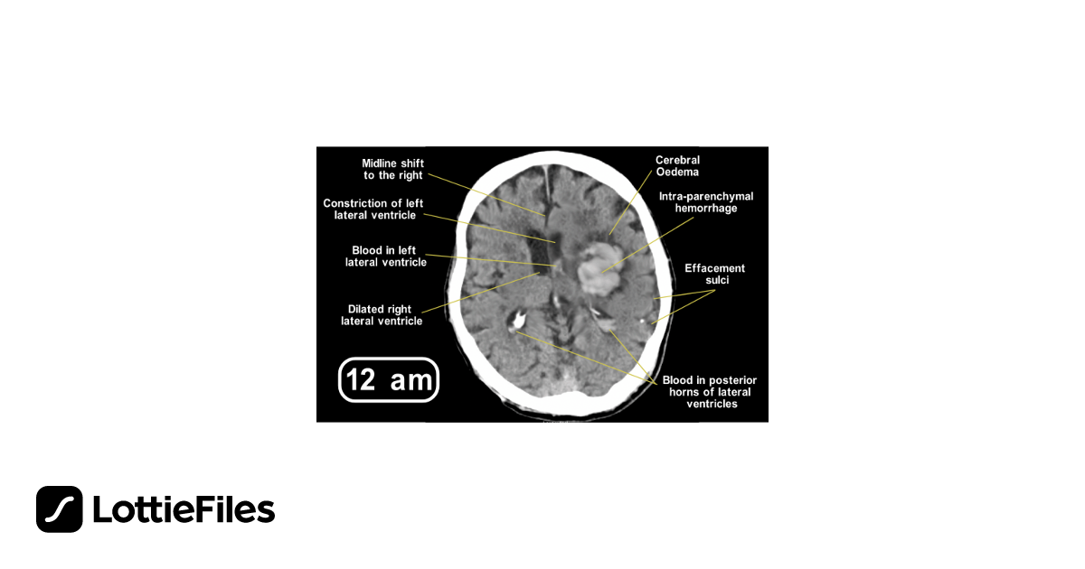 Free The evolution of an intra-parenchymal brain haemorrhage over 24 ...