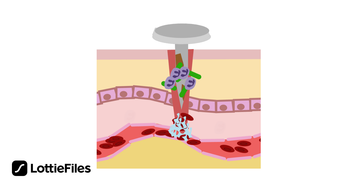 Free Accute inflammation nail, formation of placelets and neutrophil ...
