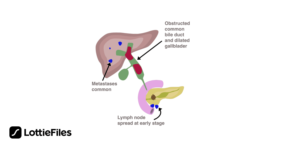 Free Pancreatic cancer Animation by Joana Barreira | LottieFiles